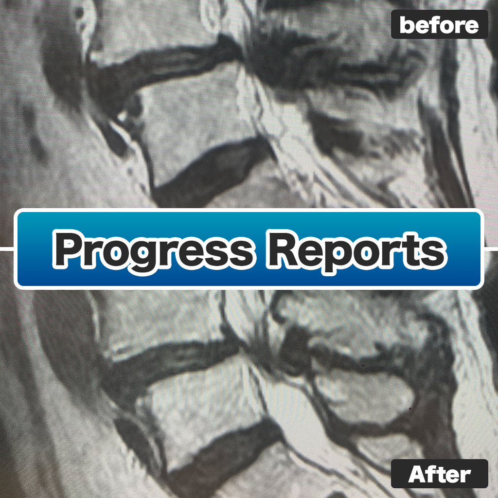 【Laporan Perkembangan Metode PLDD】Bagaimana Kondisinya Setelah 5 Tahun dari Terapi Laser? - NLC ...
